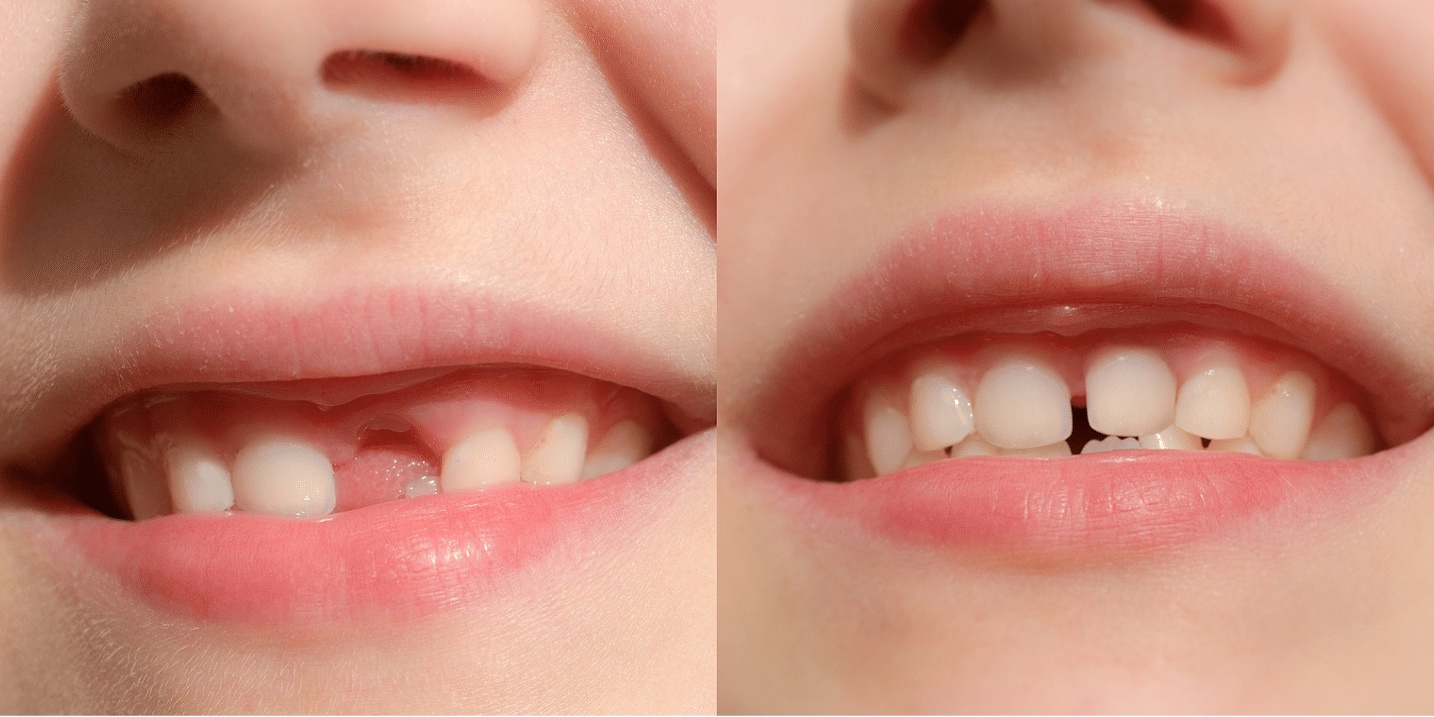 Baby Teeth Orthodontic Development | Carroll Orthodontics